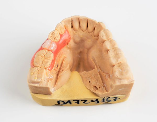 Nesbit Flexible Partial Denture – Dental Lab Direct
