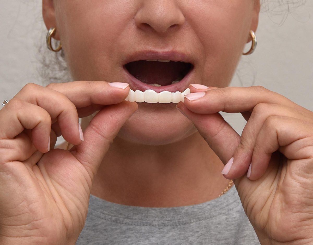 Everything You Need to Know About Snap-On Veneers - Dental Lab Direct